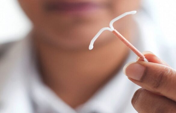 What is the Mirena IUD and its side effects? - Fastlyheal